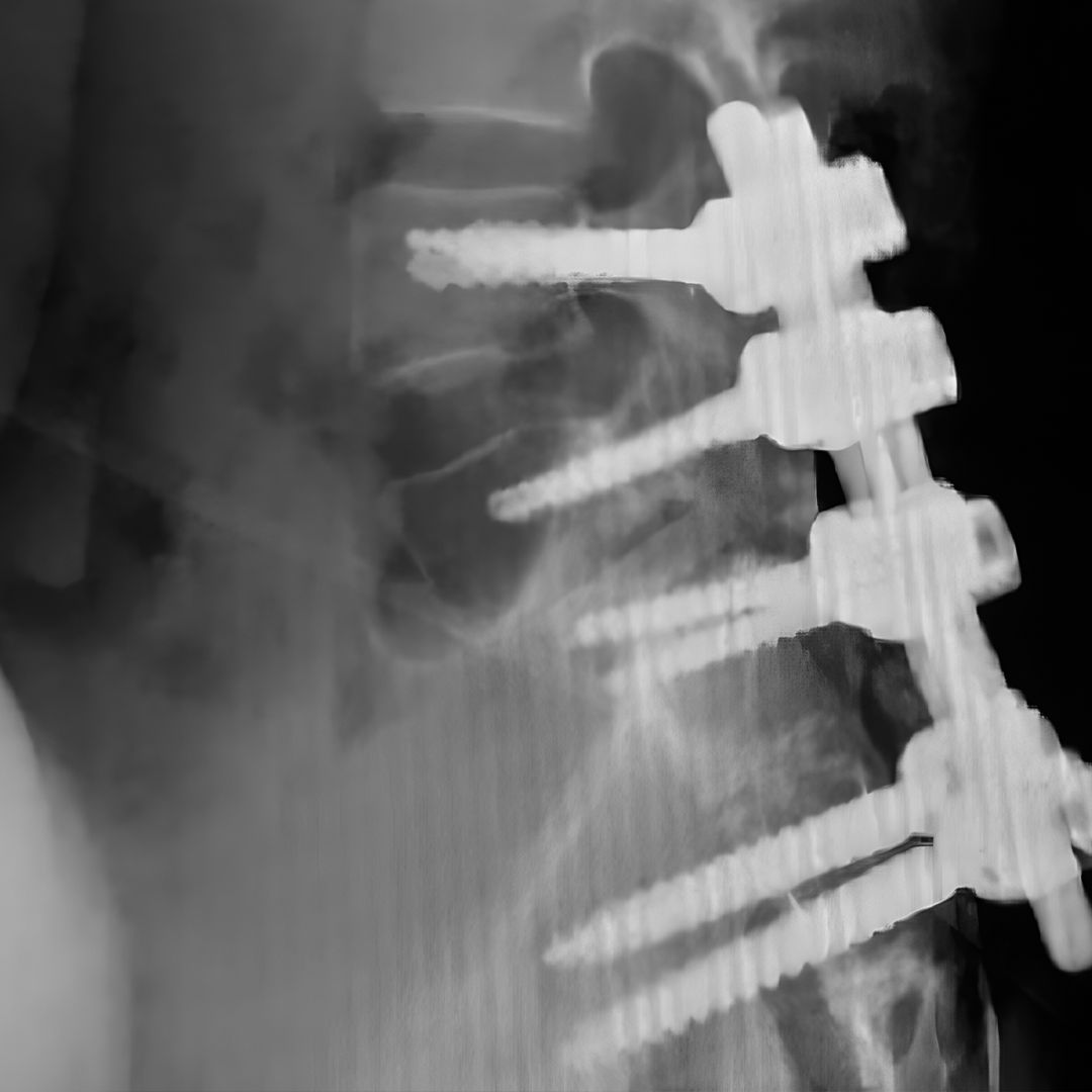 Bonefill Porous Bloco - Portal | Bionnovation