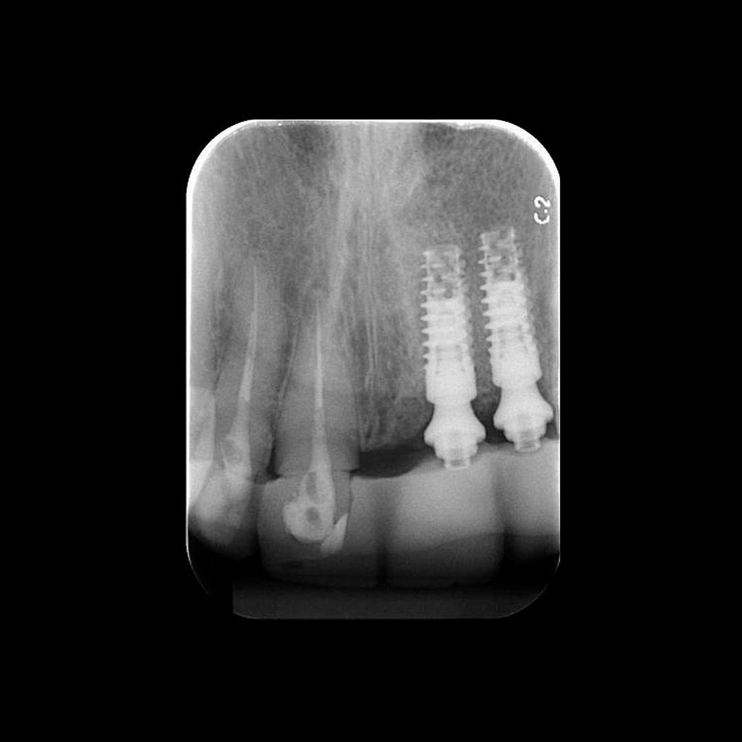 Bonefill Granulado - Bionnovation